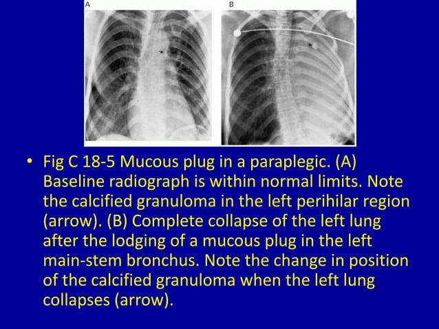 18 lobar or segmental collapse | PPTX | Lung and Respiratory Health ...