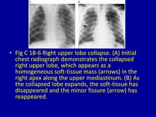 18 lobar or segmental collapse | PPTX | Lung and Respiratory Health ...