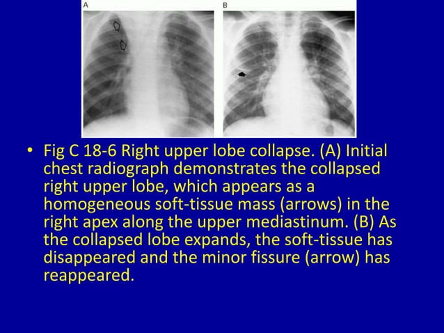 18 lobar or segmental collapse | PPTX | Lung and Respiratory Health ...