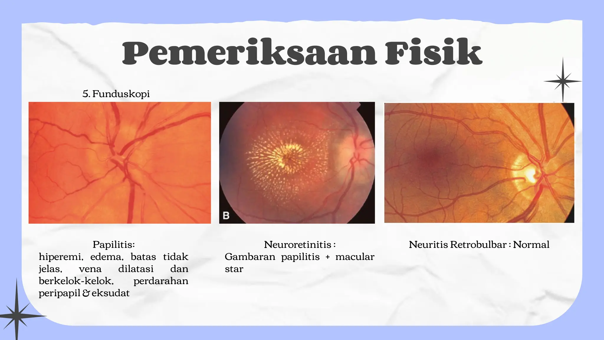 Neuritis Optik | PDF