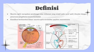 Neuritis Optik | PDF