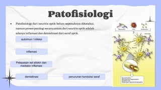 Neuritis Optik | PDF