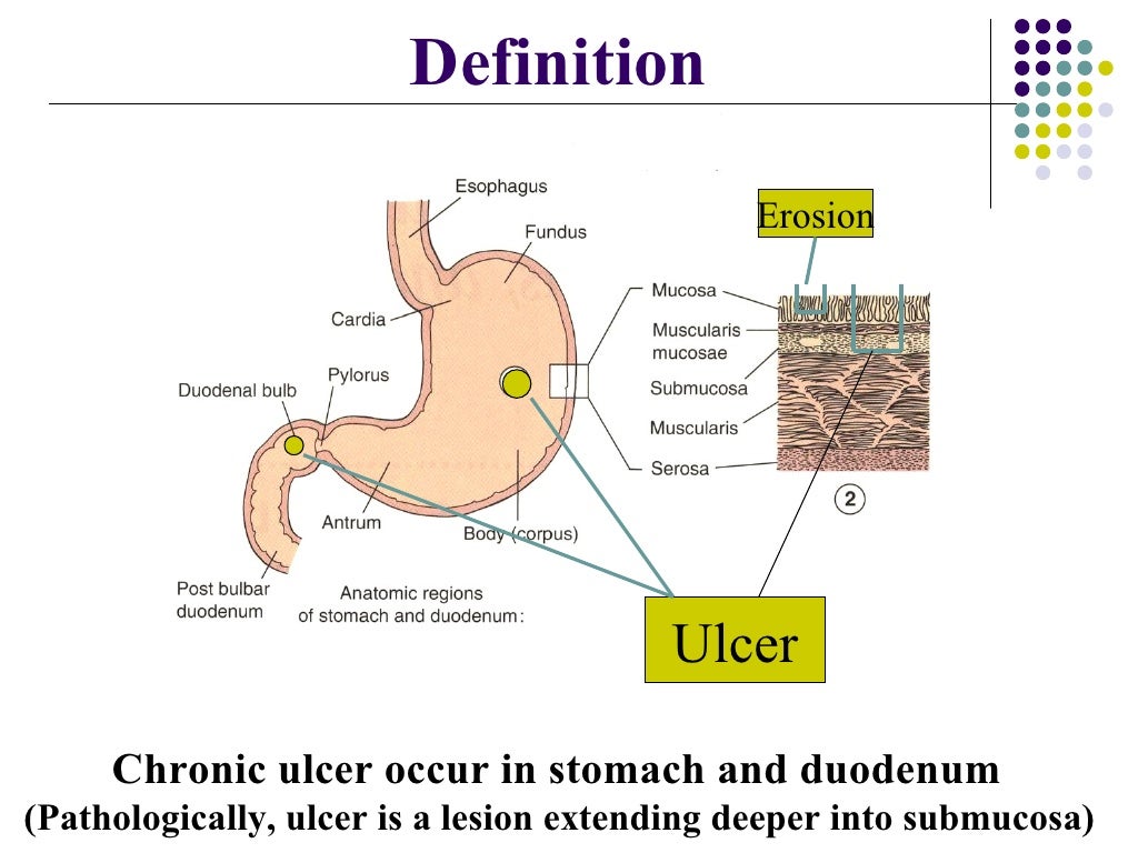 18 peptic ulcer