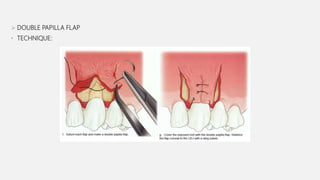 Perioplastic surgeries- width of attached gingiva | PPT