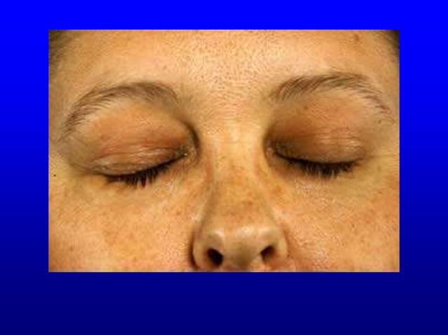 18photodermatitis.ppt