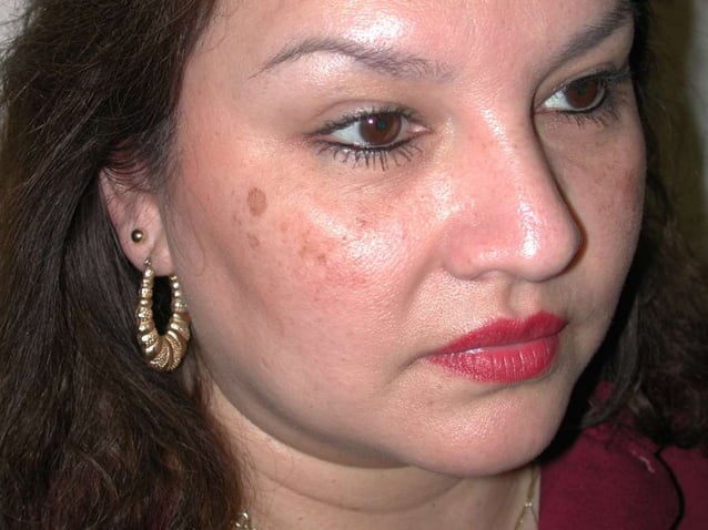 18photodermatitis.ppt