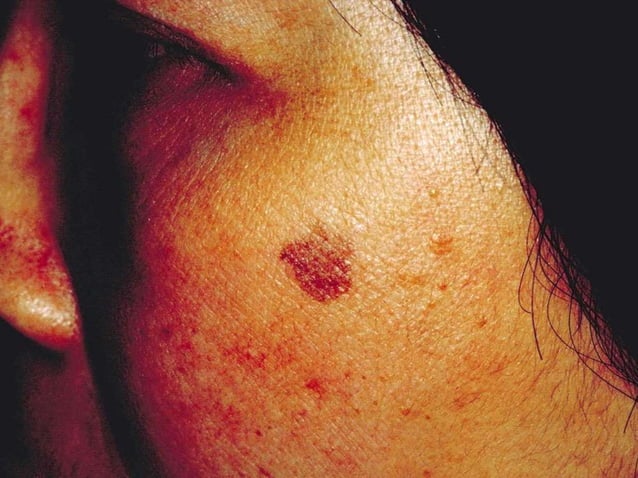 18photodermatitis.ppt