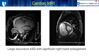 Evidence-based Management of Atrial Septal Defects and Patent Foramen ...