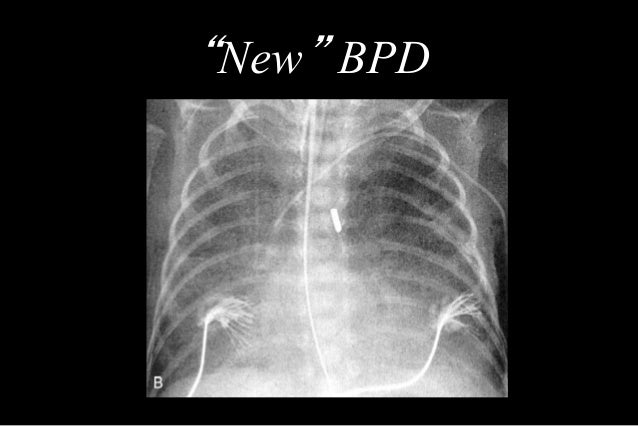 Strategies for the Prevention of Bronchopulmonary Dysplasia: Wishful