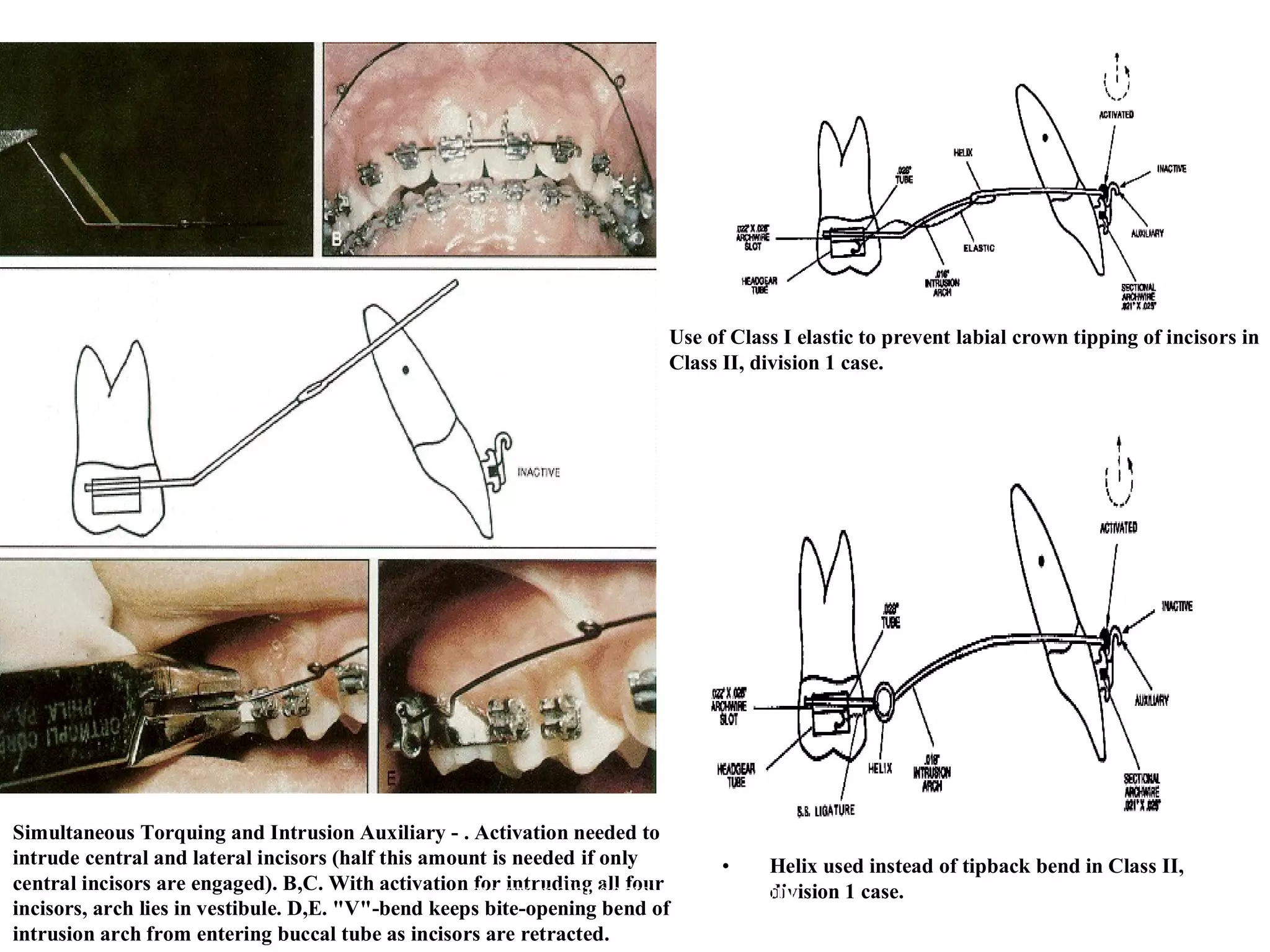 Simultaneous Torquing & Intrusion /certified fixed orthodontic courses by Indian dental academy ...