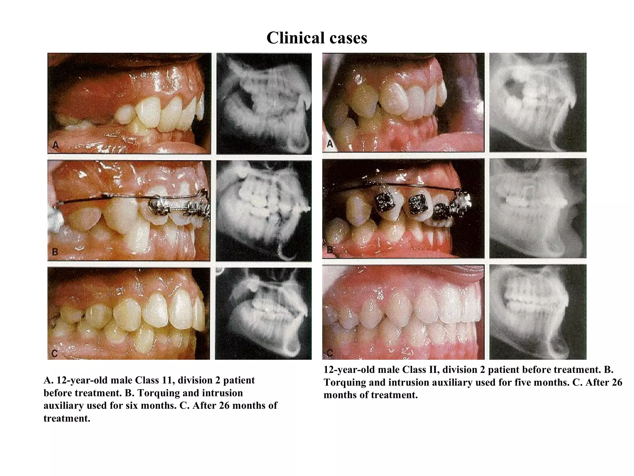 Simultaneous Torquing & Intrusion /certified fixed orthodontic courses by Indian dental academy ...