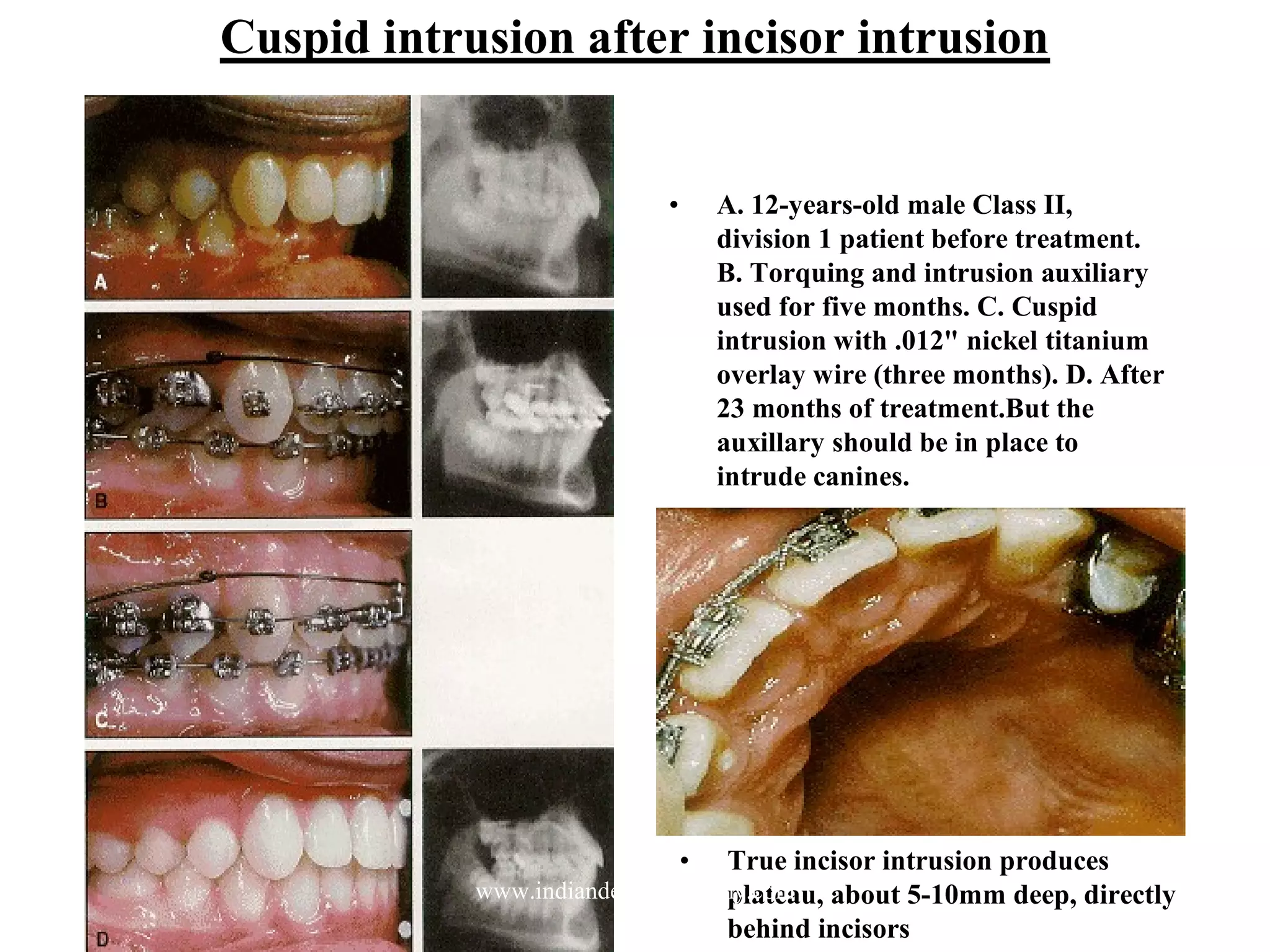 Simultaneous Torquing & Intrusion /certified fixed orthodontic courses by Indian dental academy ...