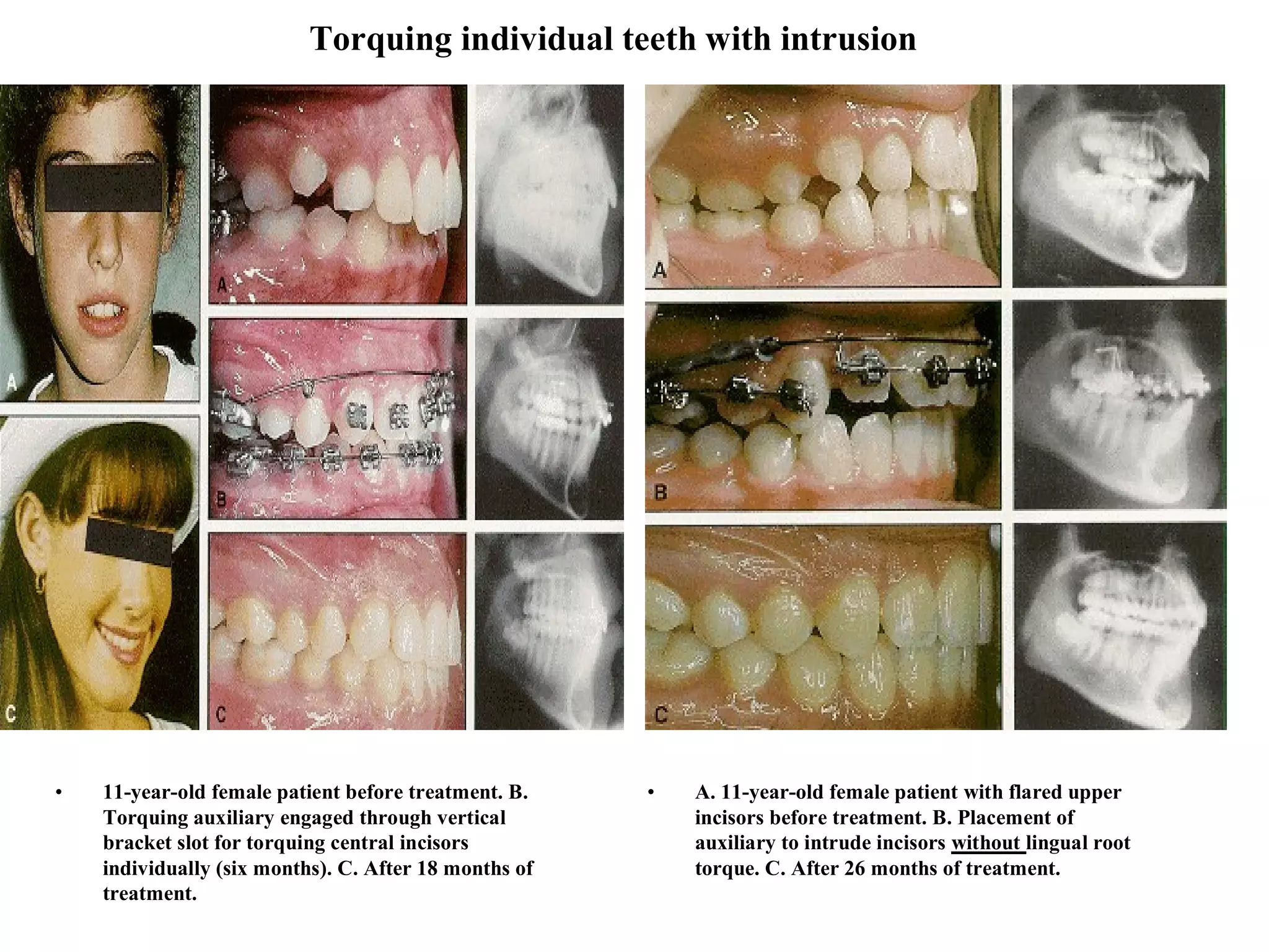 Simultaneous Torquing & Intrusion /certified fixed orthodontic courses by Indian dental academy ...