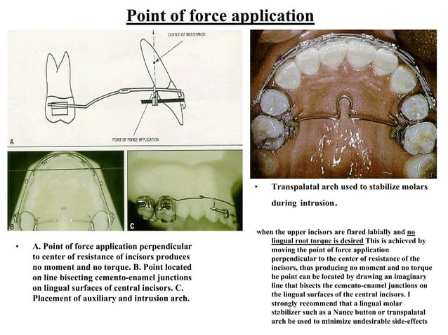 Simultaneous Torquing & Intrusion /certified fixed orthodontic courses by Indian dental academy ...