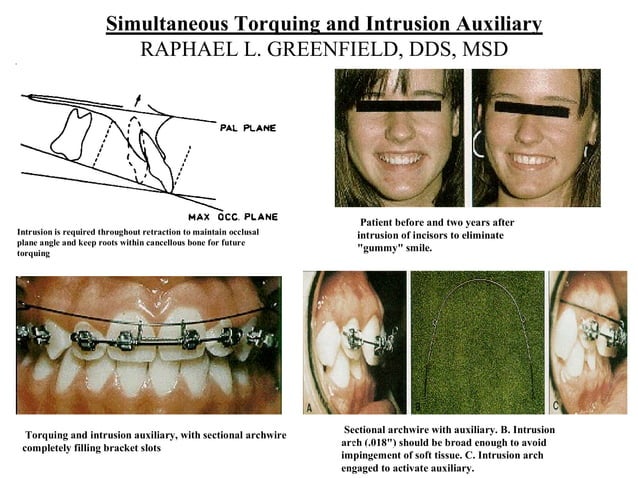 Simultaneous Torquing & Intrusion /certified fixed orthodontic courses by Indian dental academy ...