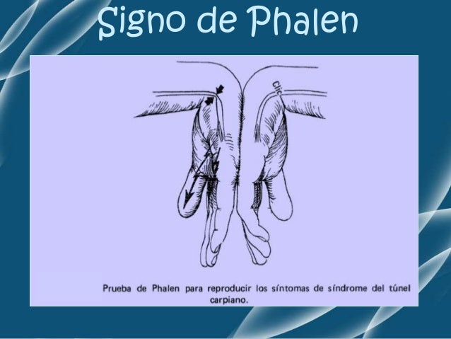 18 sindrome del tunel del carpo