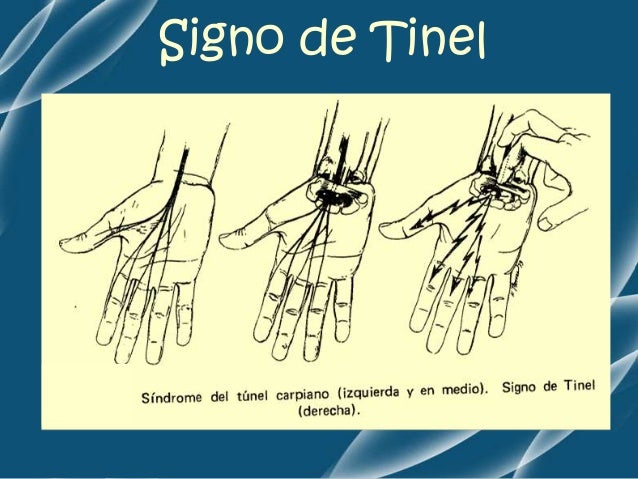 18 sindrome del tunel del carpo
