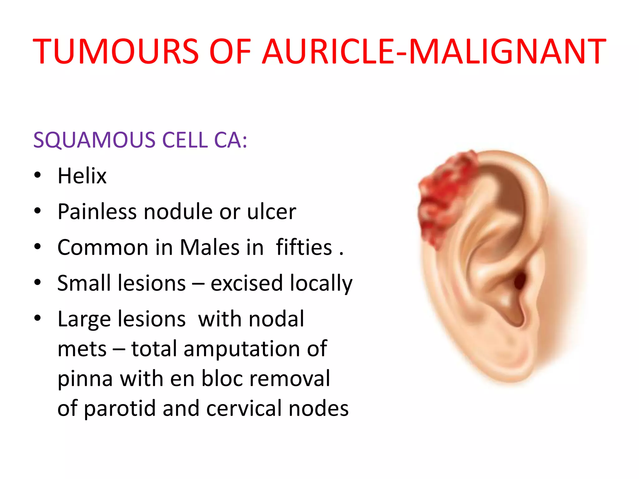 Tumours of External Auditory Canal and Middle Ear | PPTX