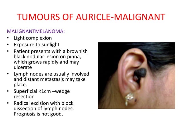 Tumours of External Auditory Canal and Middle Ear | PPTX | Ear, Nose ...