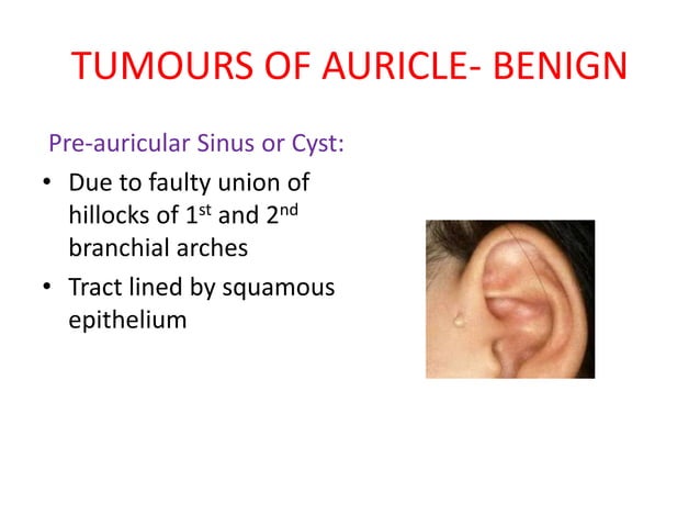 Tumours of External Auditory Canal and Middle Ear | PPTX | Ear, Nose ...