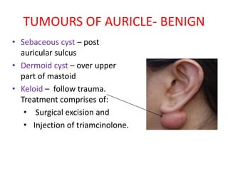 Tumours of External Auditory Canal and Middle Ear | PPTX
