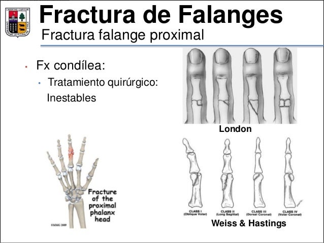 19. seminario fx escafoides, mtc y falanges. df