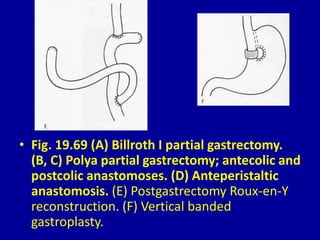 Polya Gastrectomy
