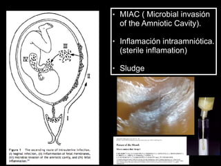 Inflamación e infección intraamniótica y parto pretérmino. Certezas y ...