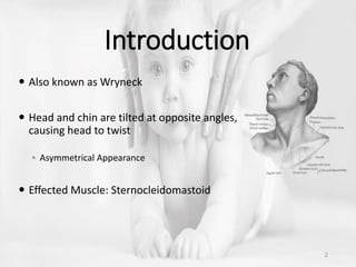 19. torticollis | PPTX