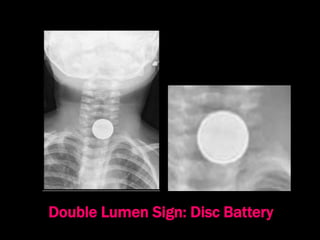 Foreign Bodies in Aerodigestive Tract | PPT