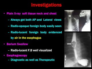 19. foreign bodies in aerodigestive tract | PPT