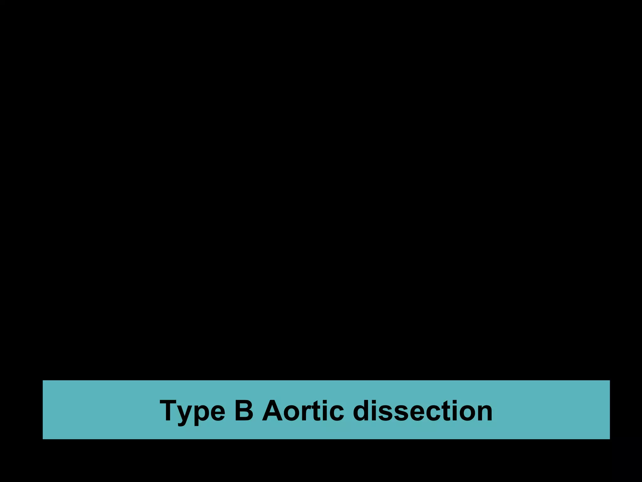 Type B AORTIC DISSECTION | PPTX