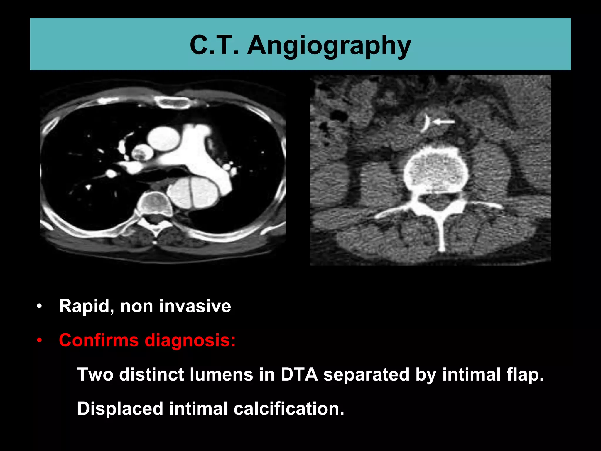 Type B AORTIC DISSECTION | PPTX