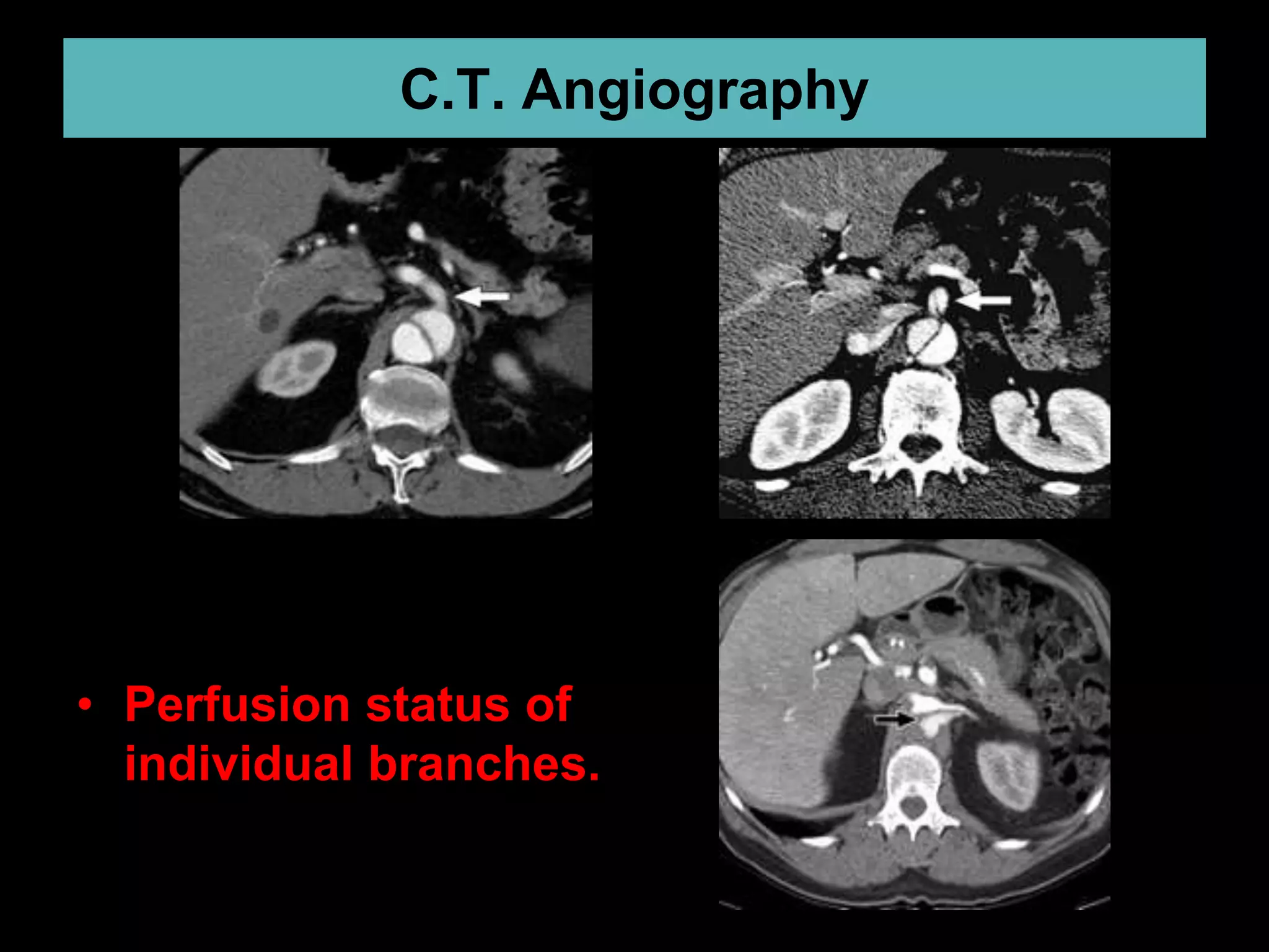 Type B AORTIC DISSECTION | PPTX