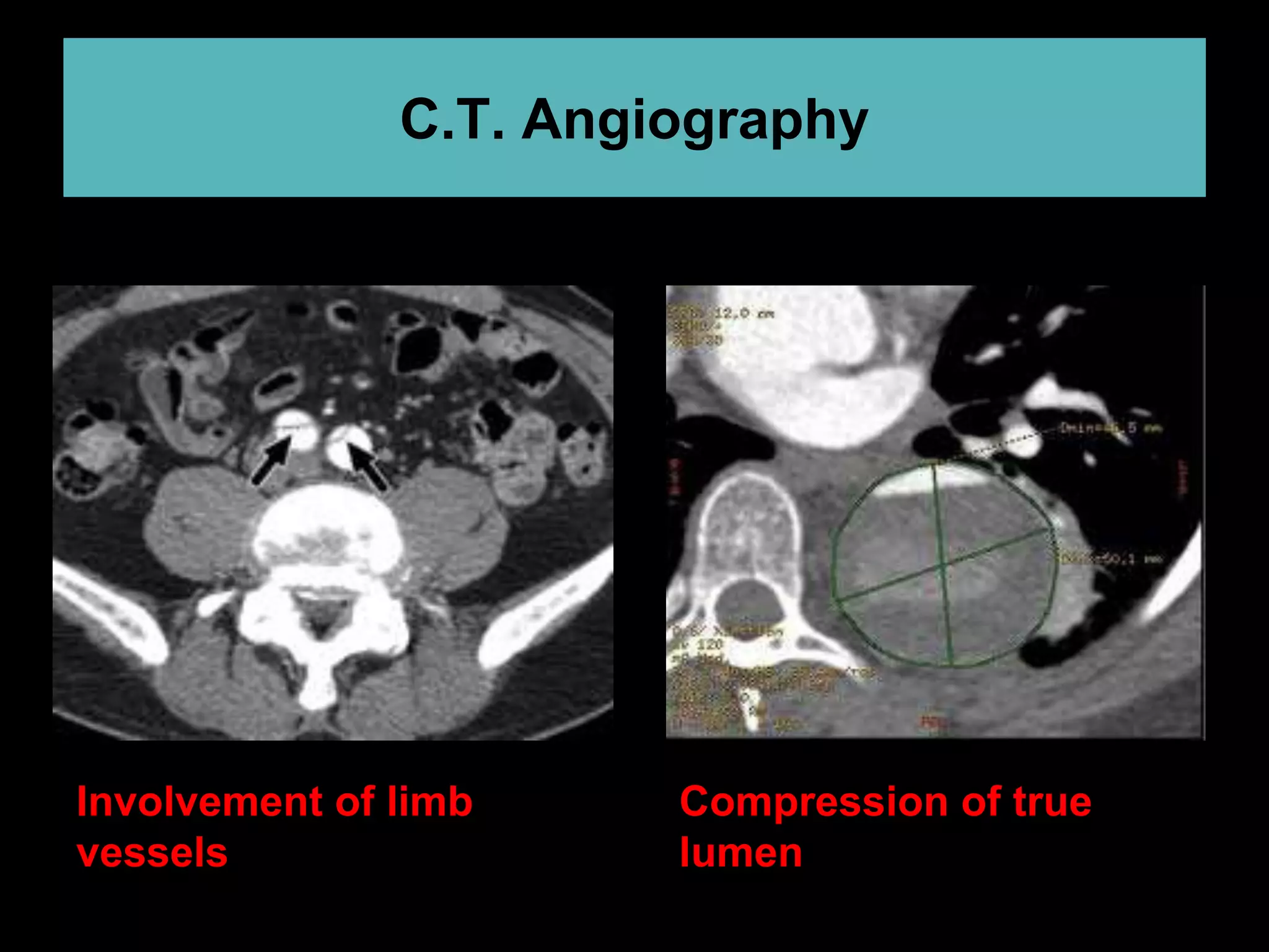 Type B AORTIC DISSECTION | PPTX