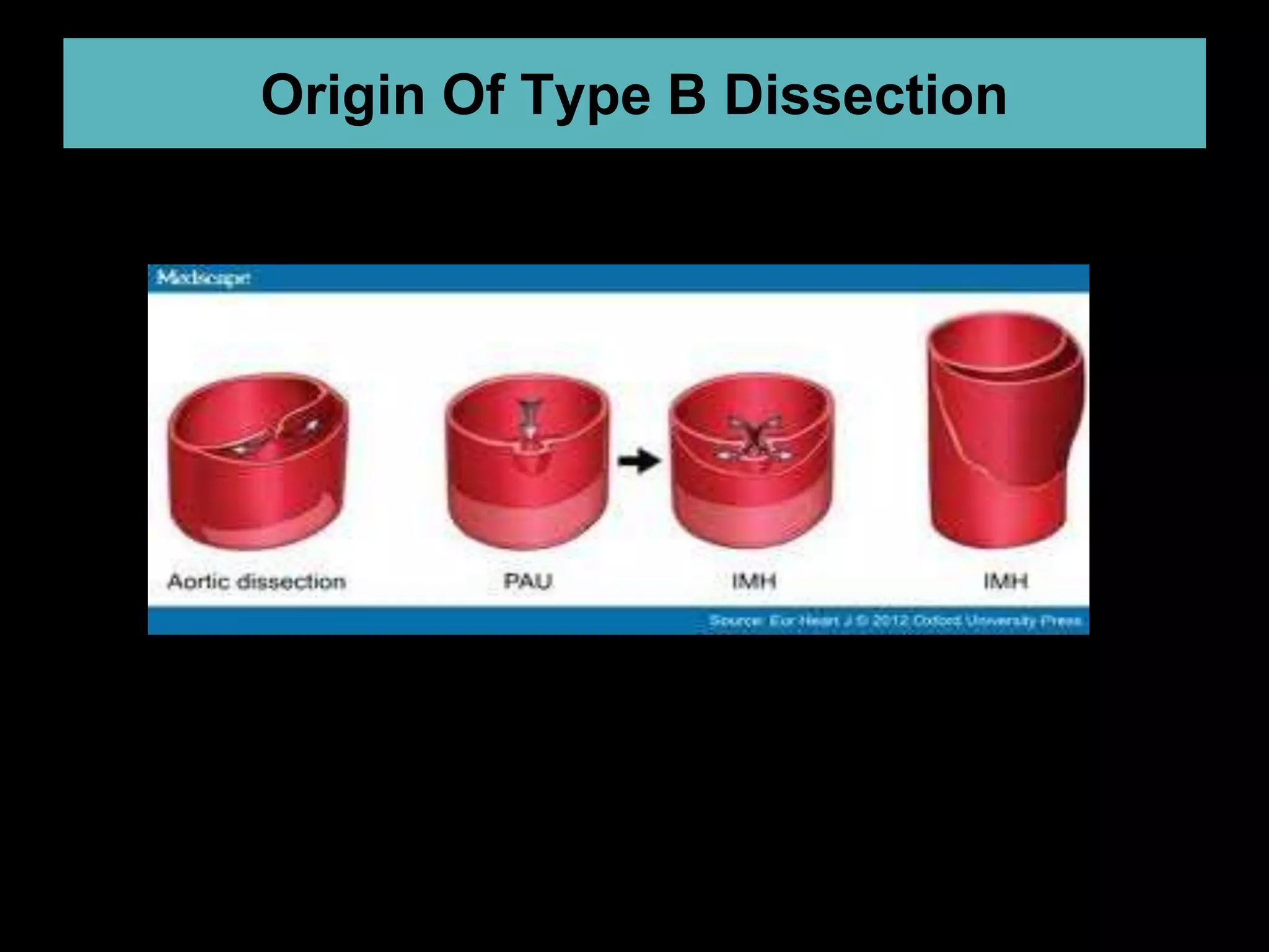 Type B AORTIC DISSECTION | PPTX