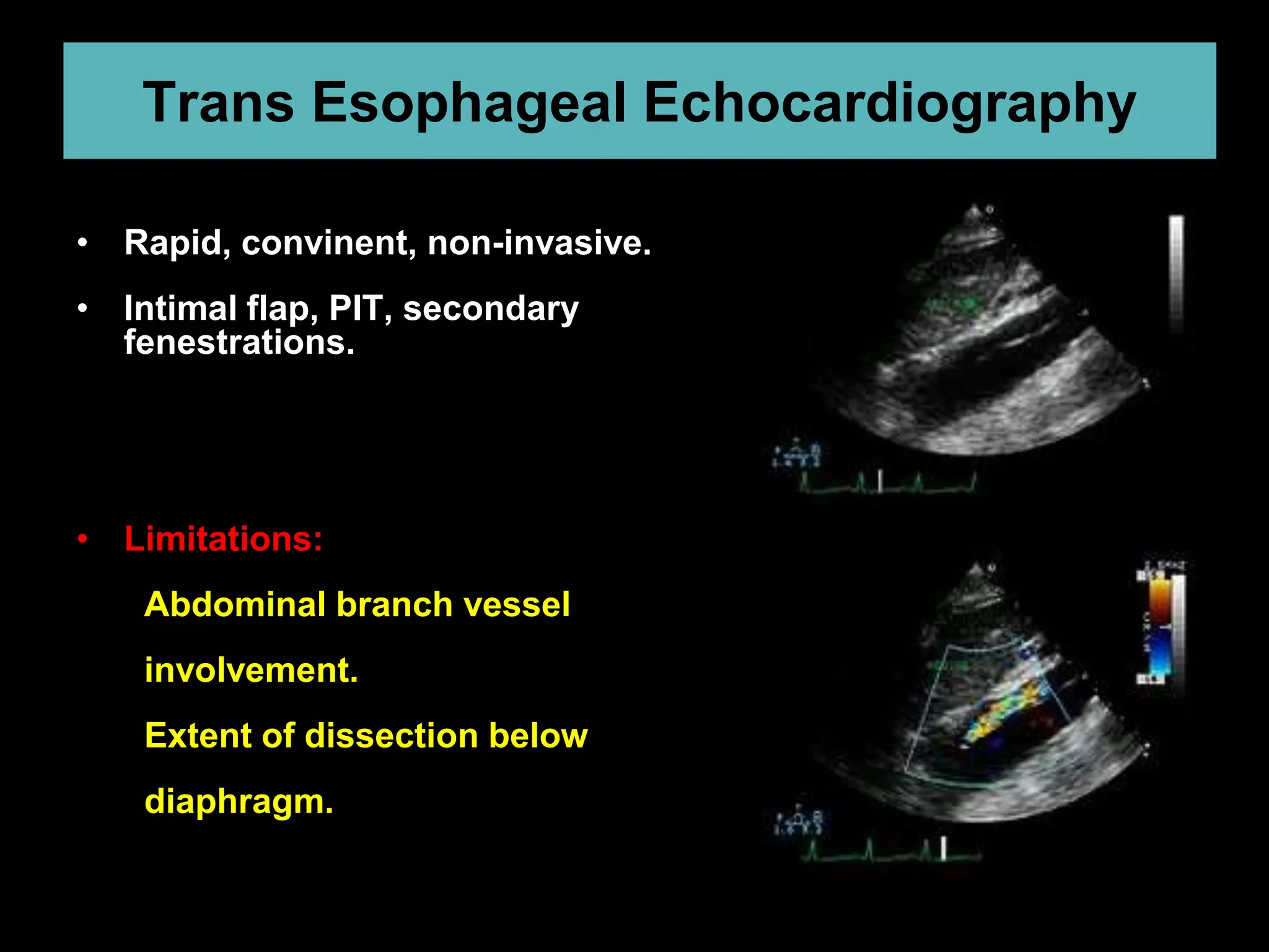 Type B AORTIC DISSECTION | PPTX