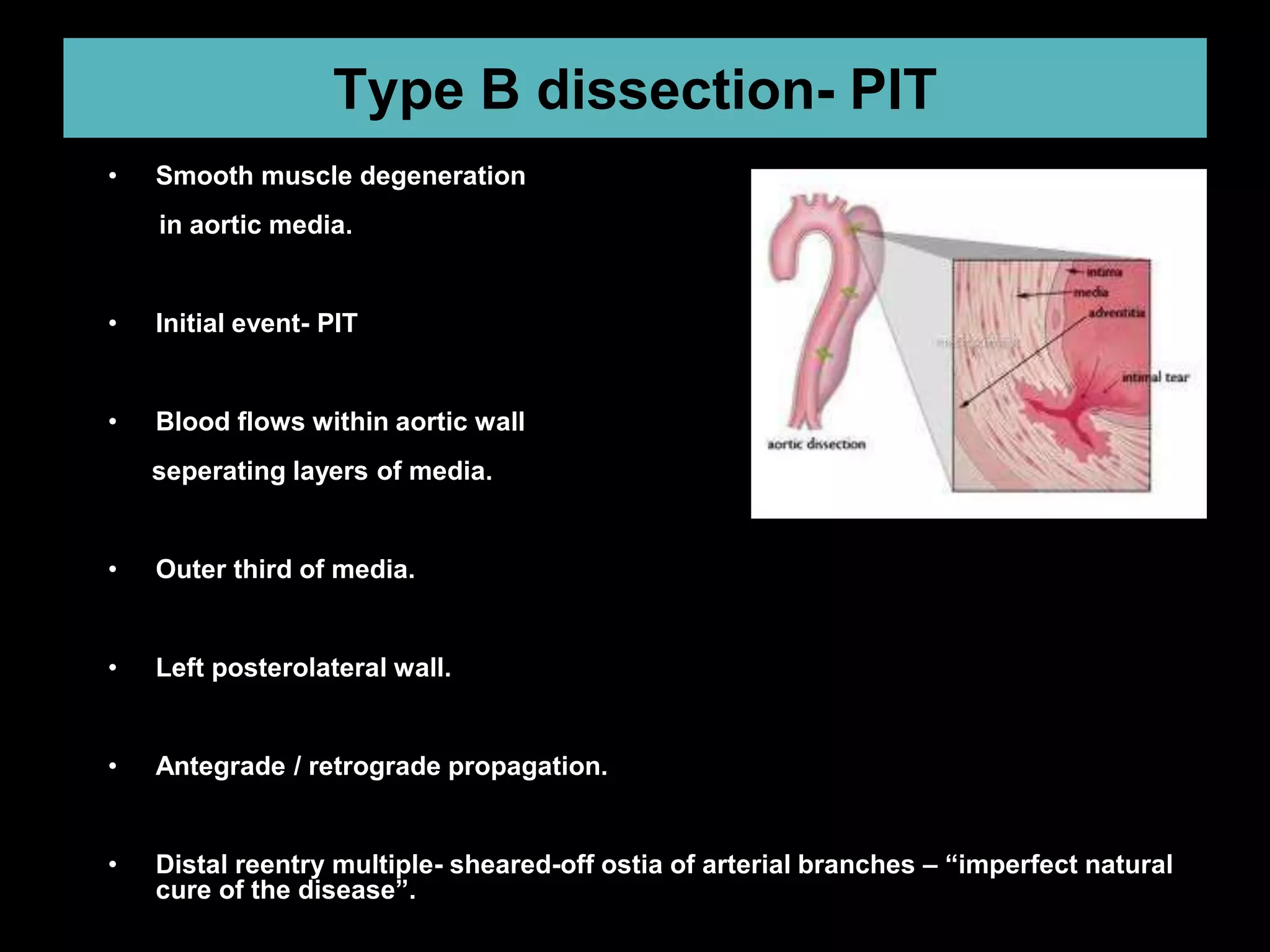 Type B AORTIC DISSECTION | PPTX