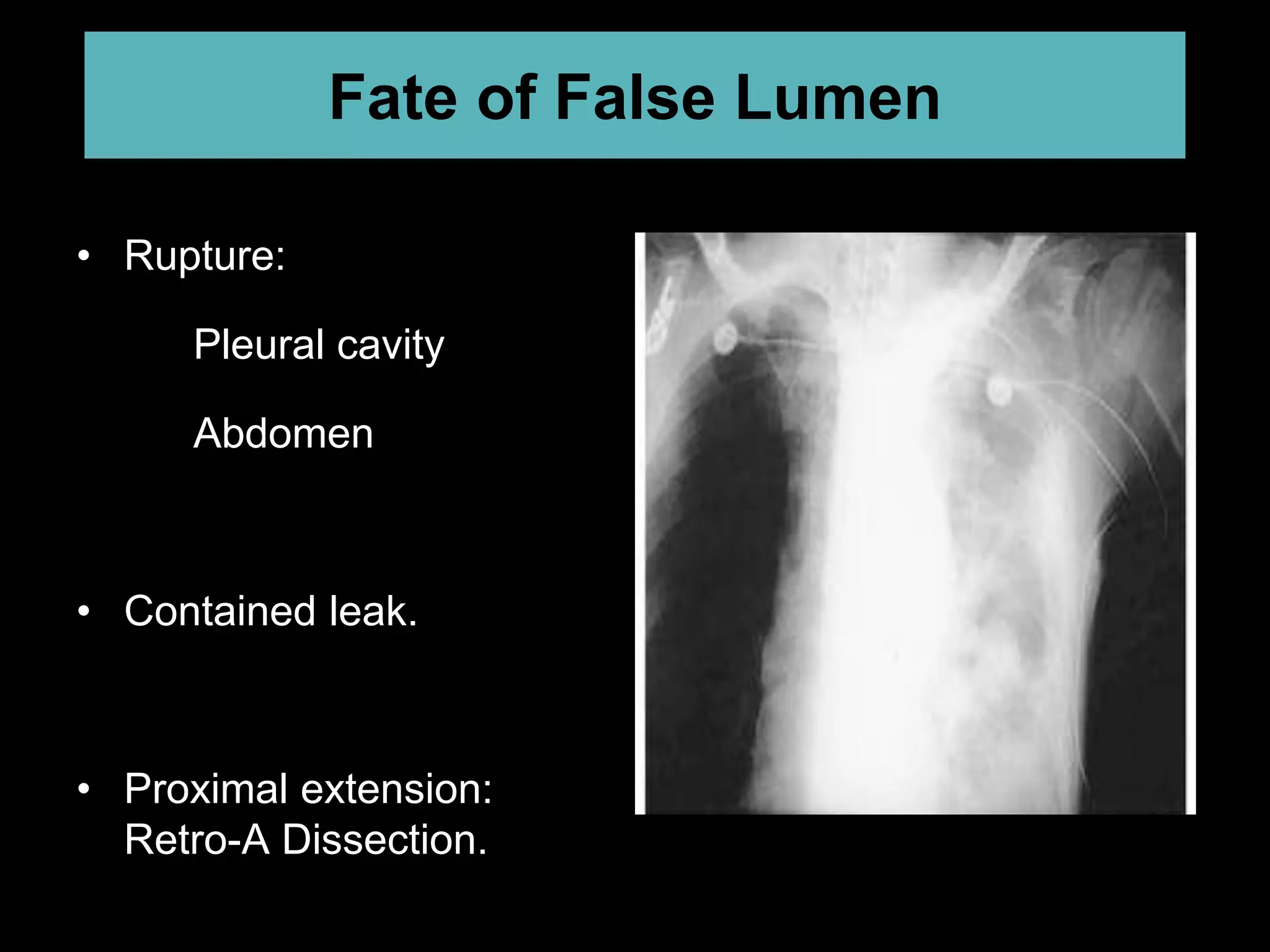 Type B AORTIC DISSECTION | PPTX