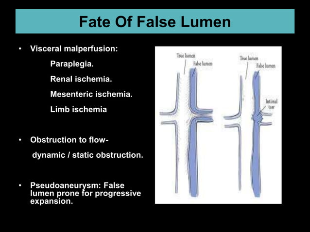 Type B AORTIC DISSECTION | PPTX