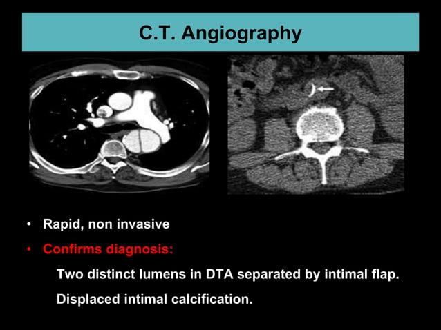 Type B AORTIC DISSECTION | PPTX