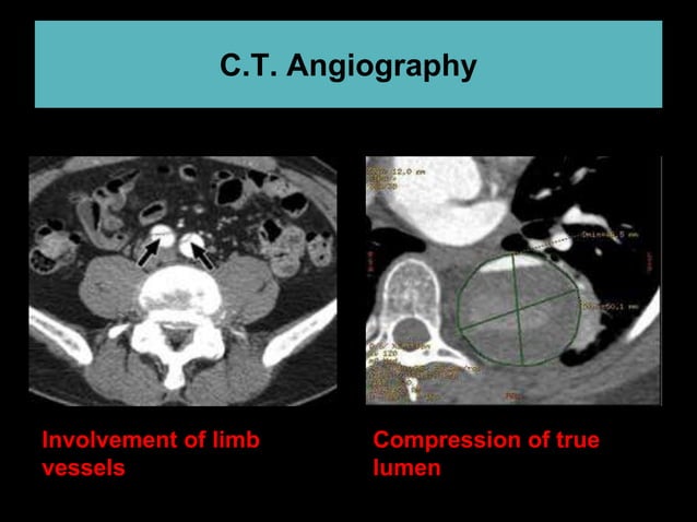 Type B AORTIC DISSECTION | PPTX