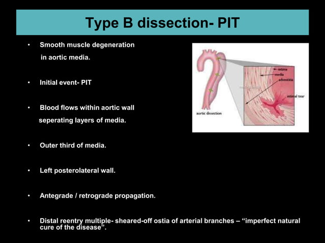 Type B AORTIC DISSECTION | PPTX
