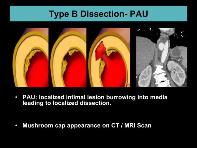 Type B AORTIC DISSECTION | PPTX