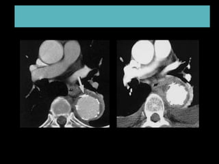 Type B AORTIC DISSECTION | PPTX