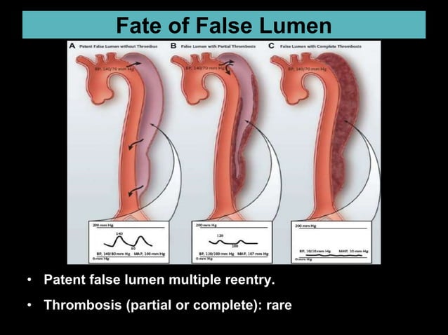 Type B AORTIC DISSECTION | PPTX