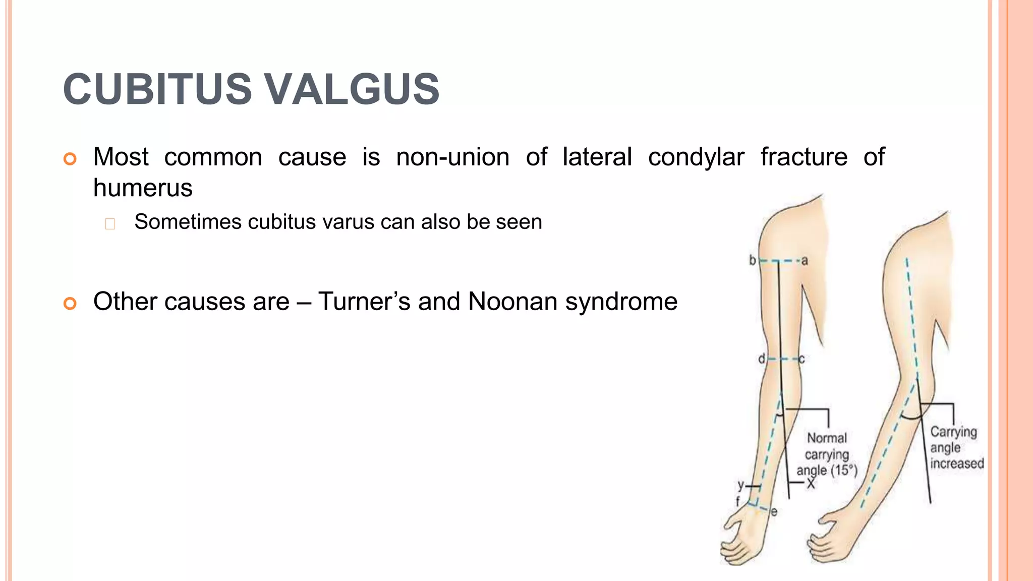Cubitus varus and valgus | PPTX