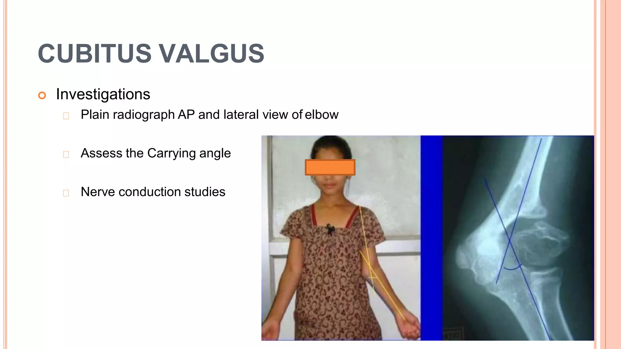 Cubitus varus and valgus | PPTX
