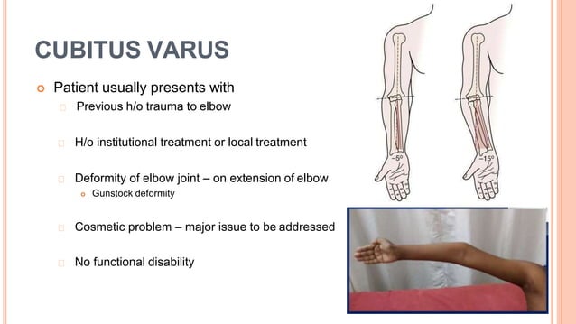 Cubitus varus and valgus