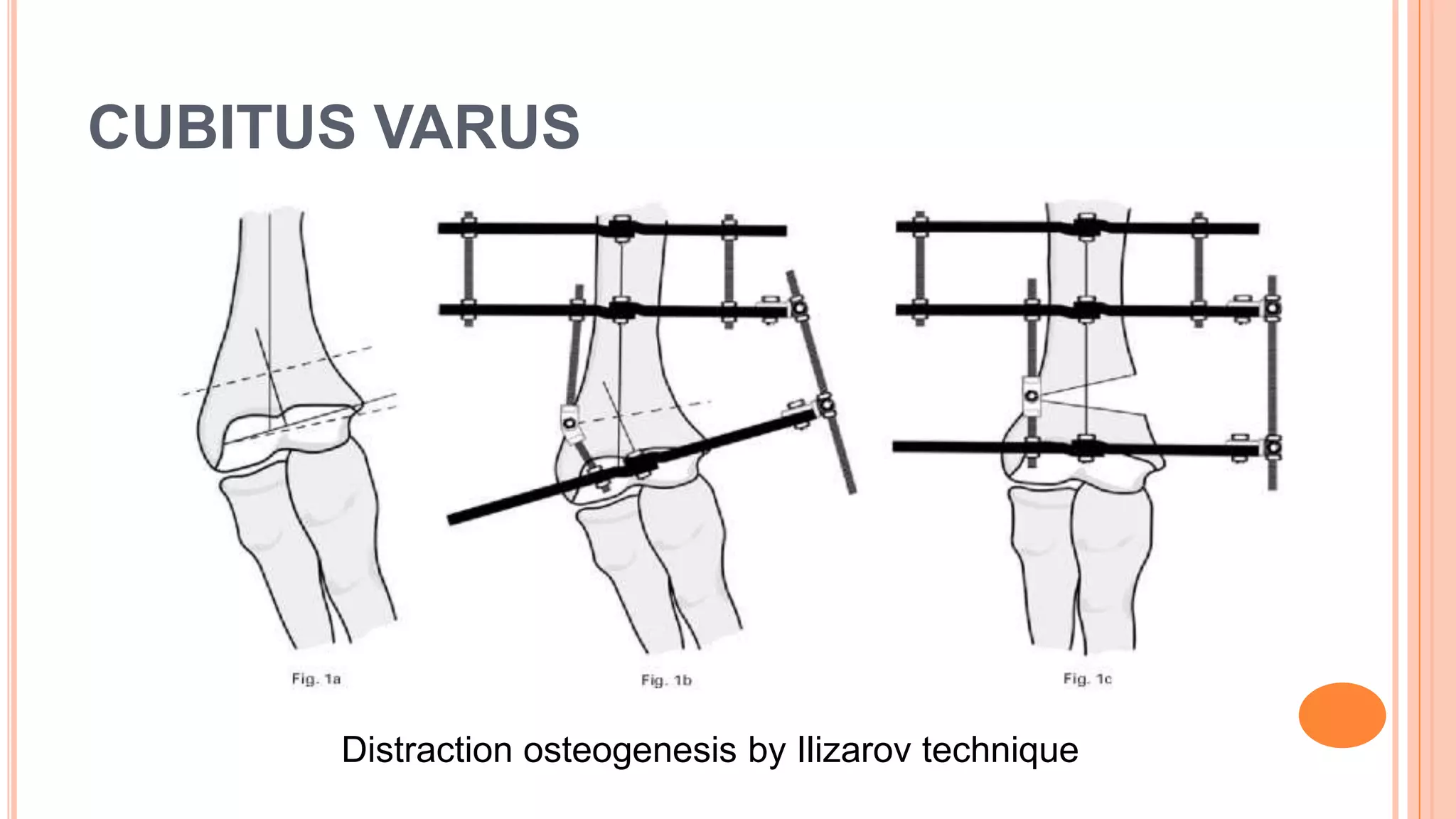 Cubitus varus and valgus | PPTX